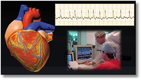 CARDIOLOGIA: FIBRILACION AURICULAR-FA